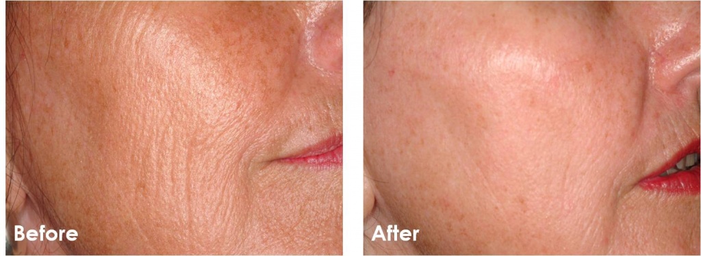 How Does Skin Resurfacing Work? | Navigating Healthcare