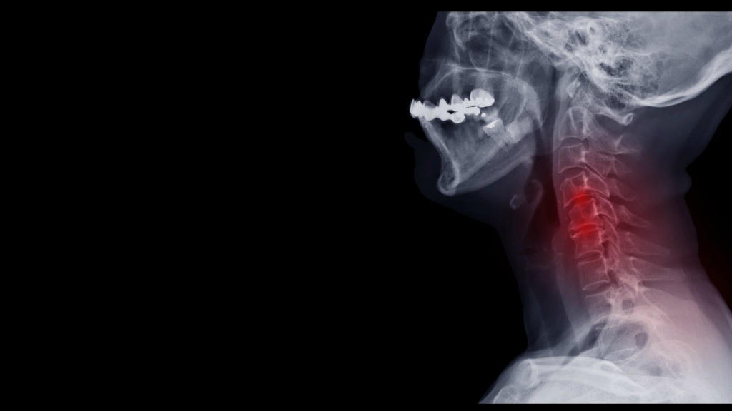 Understanding Cervical Spinal Fusion | Navigating Healthcare